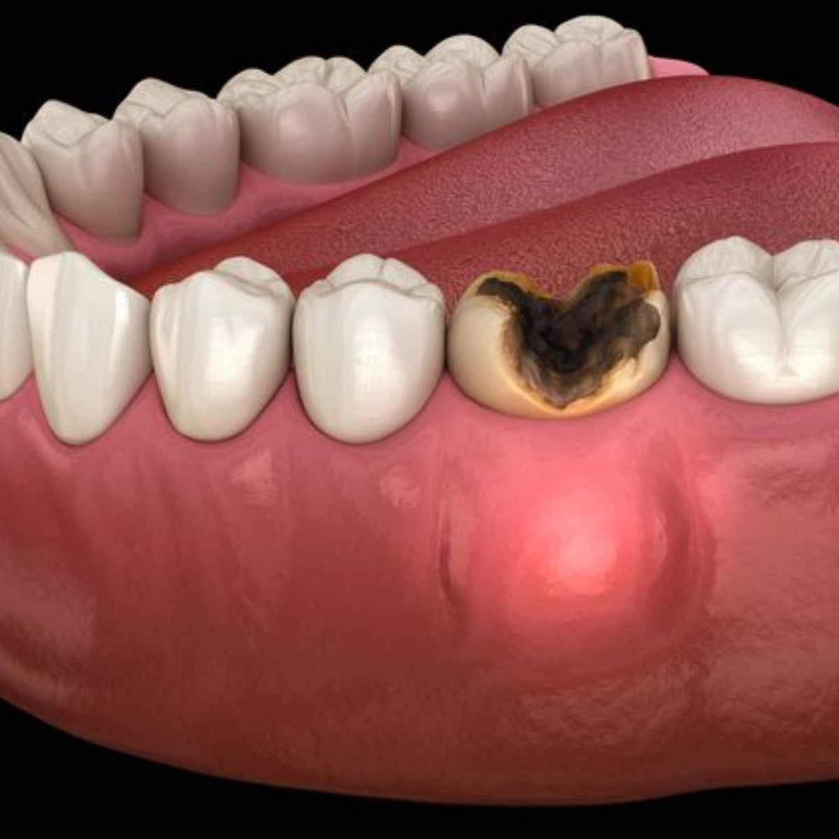 Efficacy Evaluation Of Zirconia Crown On Primary Molars With Caries De Wissden