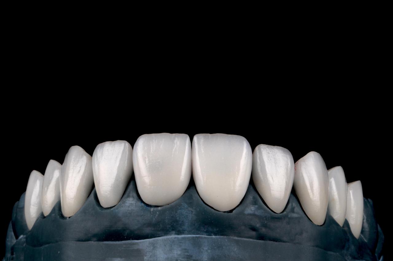 Lithium disilicate – Wissden